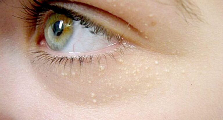 Xantelasma – Clínica Emmanuelle Bertoldi